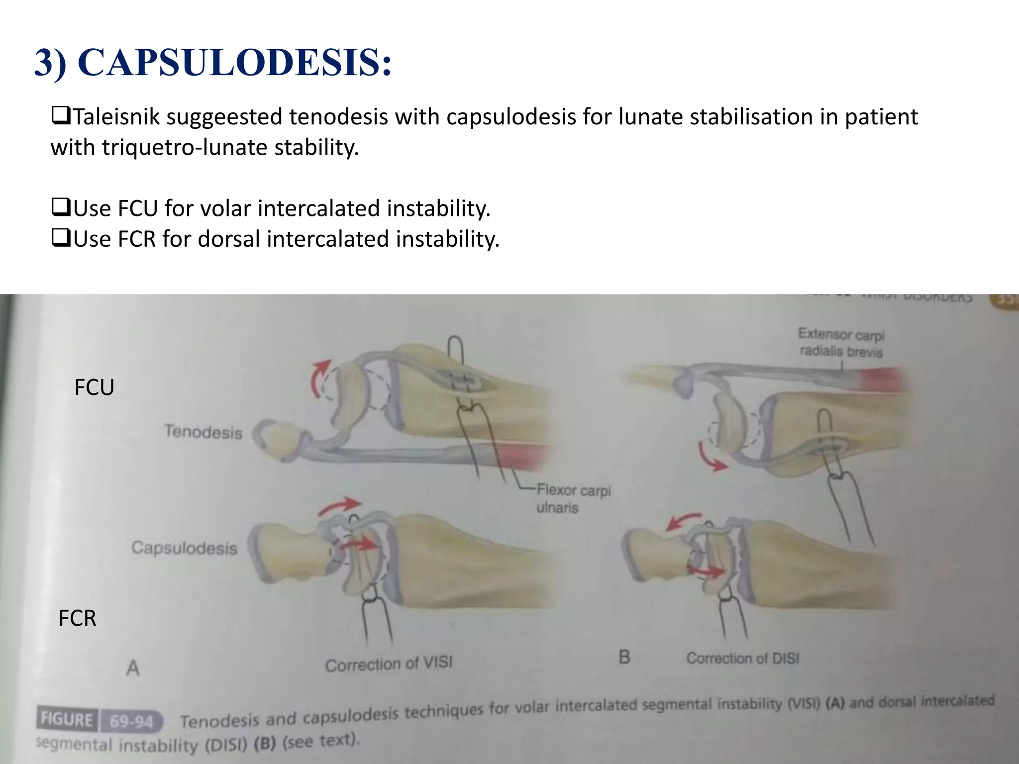 Lunate Fracture & Perilunate dislocation of carpals by Dr.@rpan ...