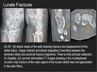 Lunate Fracture & Perilunate dislocation of carpals by Dr.@rpan ...