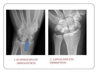 Lunate Fracture & Perilunate dislocation of carpals by Dr.@rpan ...