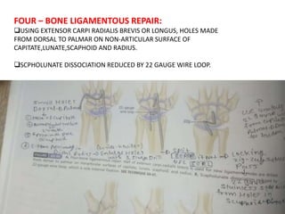 Lunate Fracture & Perilunate dislocation of carpals by Dr.@rpan ...
