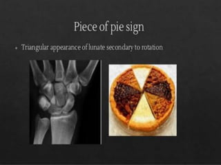 Lunate Dislocation Pie Sign