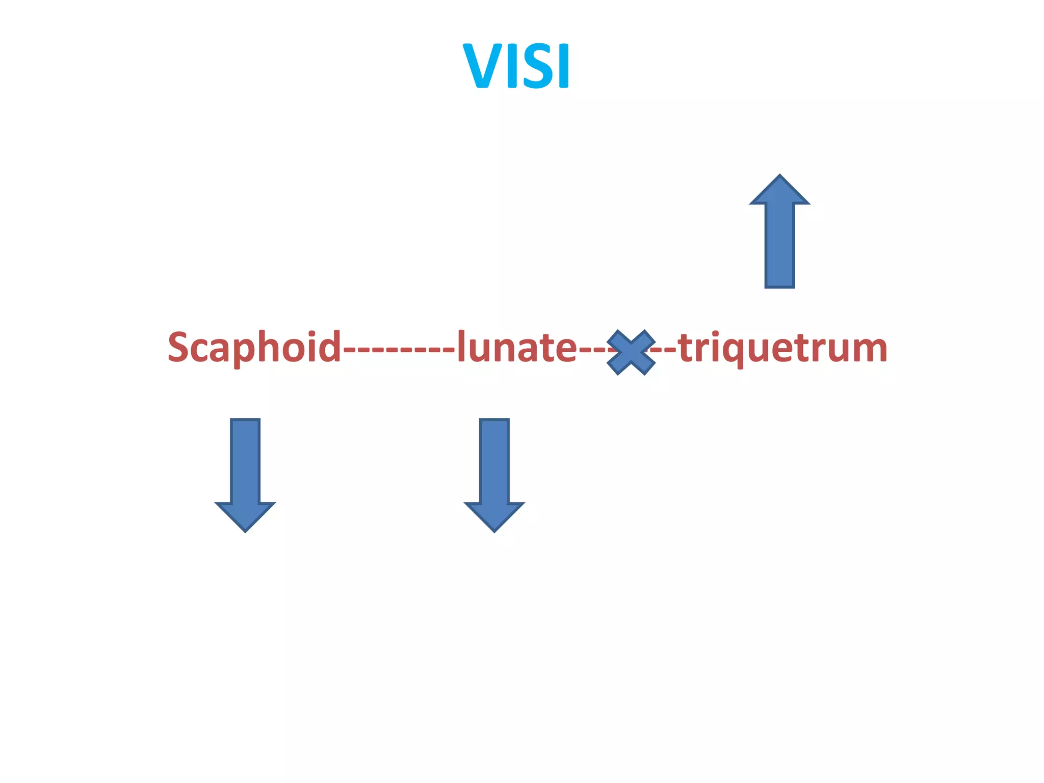 Perilunate dislocation, carpal injuries | PPTX