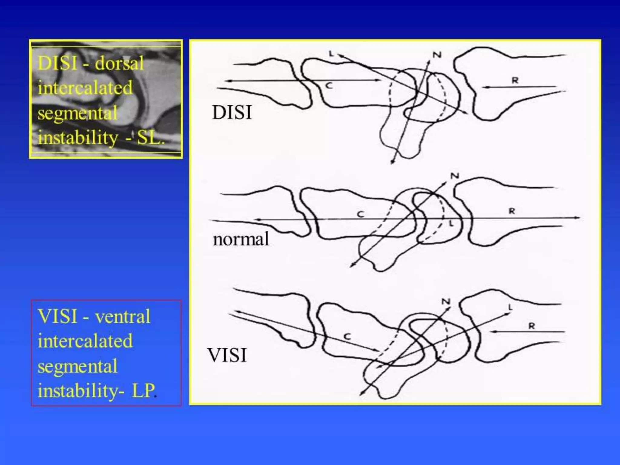 Perilunate dislocation, carpal injuries | PPTX