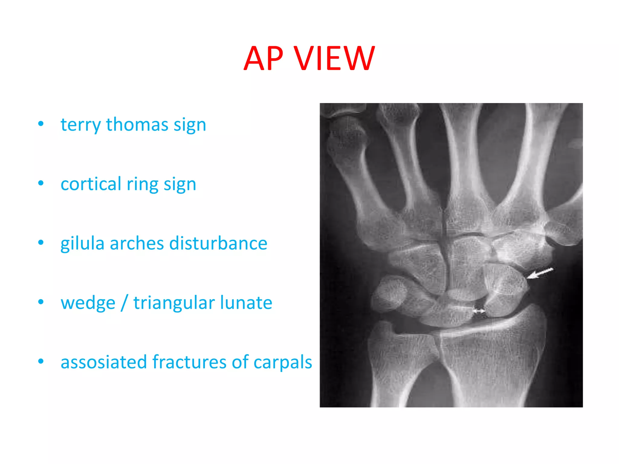 Perilunate dislocation, carpal injuries | PPTX