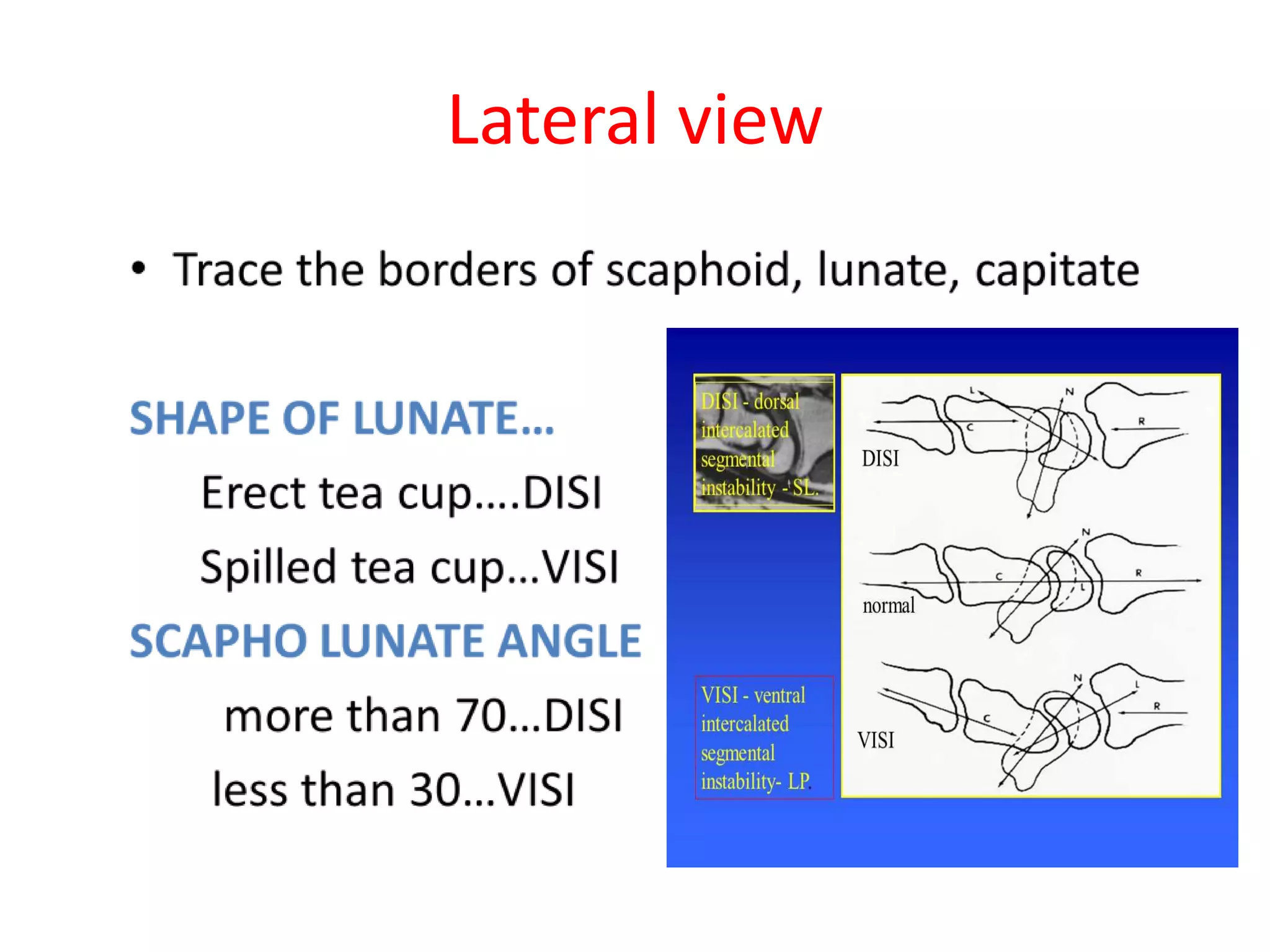 Perilunate dislocation, carpal injuries | PPTX
