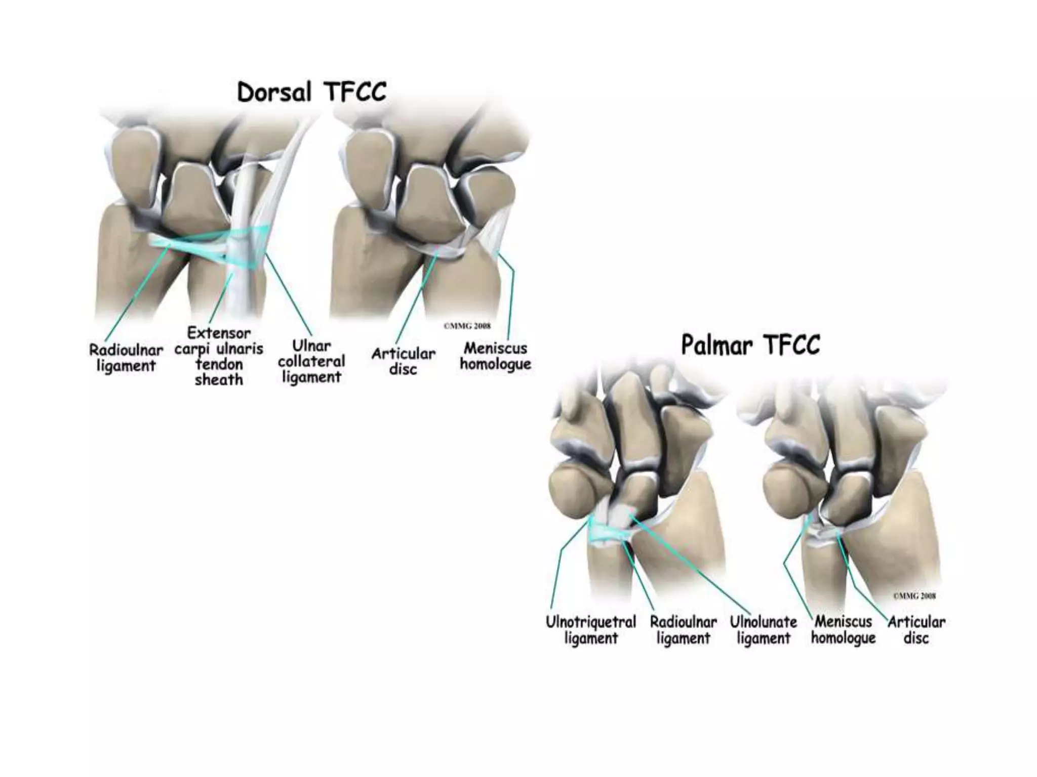 Perilunate dislocation, carpal injuries | PPTX