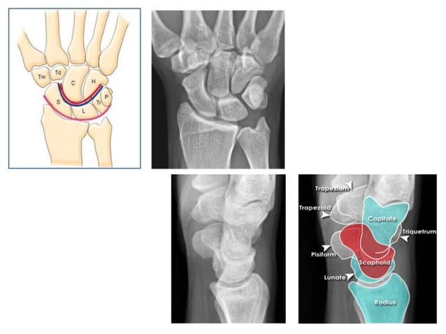 Perilunate dislocation, carpal injuries | PPTX
