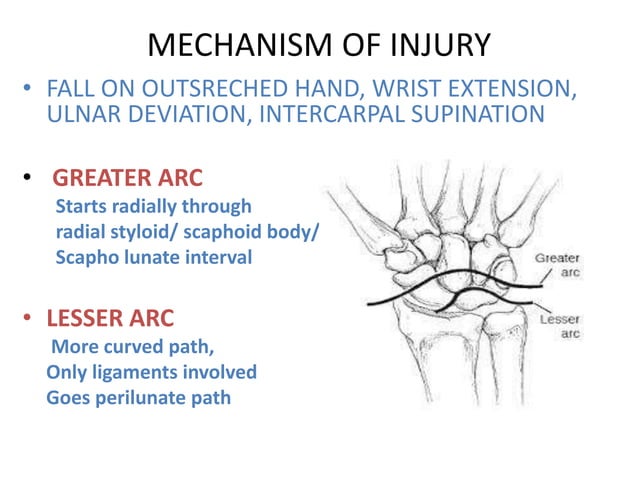 Perilunate dislocation, carpal injuries | PPTX