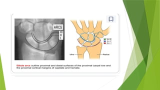 Perilunate fracture dislocation jpg.pptx