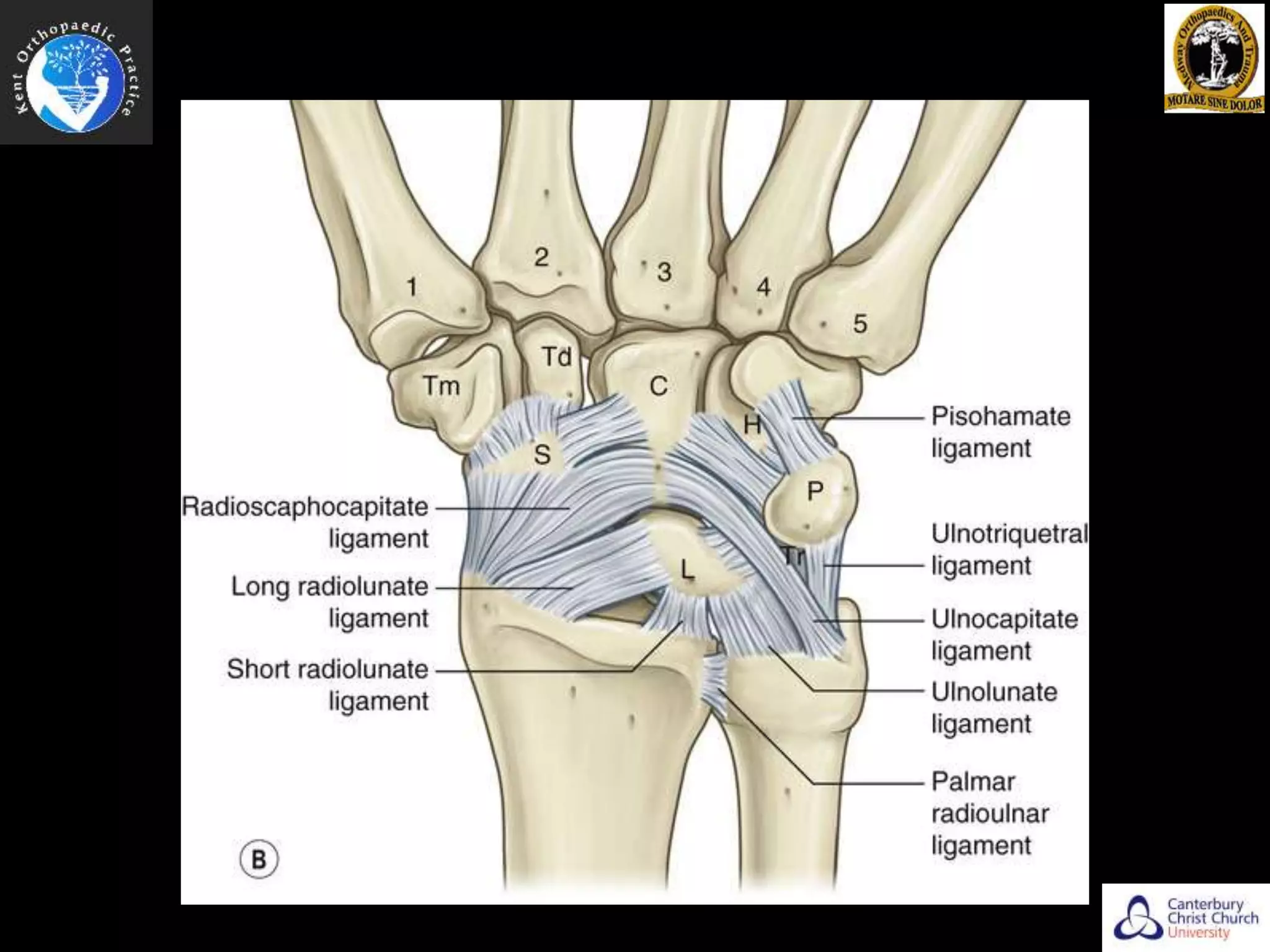 Perilunate injuries | PPTX