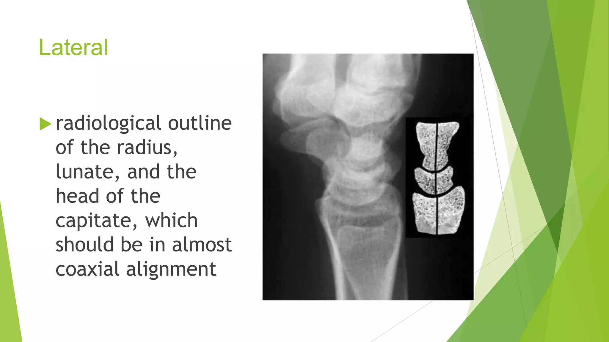Perilunate injuries and lunate dislocations [Autosaved].pptx