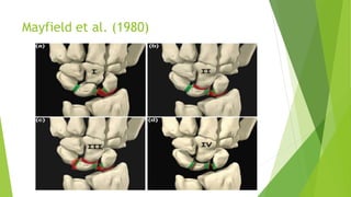 Perilunate injuries and lunate dislocations [Autosaved].pptx