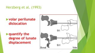 Perilunate injuries and lunate dislocations [Autosaved].pptx