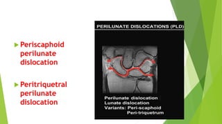 Perilunate injuries and lunate dislocations [Autosaved].pptx
