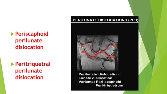 Perilunate injuries and lunate dislocations [Autosaved].pptx
