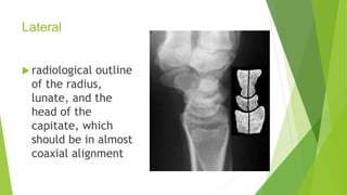 Perilunate injuries and lunate dislocations [Autosaved].pptx