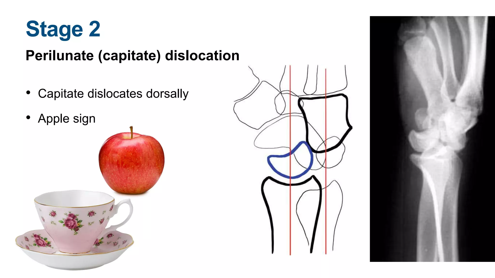 Perilunate injury | PPTX