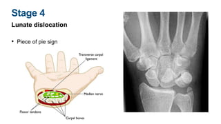 Perilunate injury | PPTX