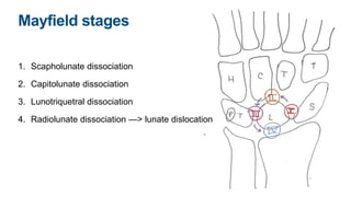 Perilunate injury | PPTX
