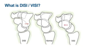 Perilunate injury | PPTX