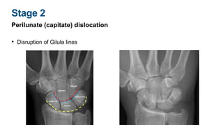 Perilunate injury | PPTX