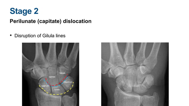 Perilunate injury | PPT