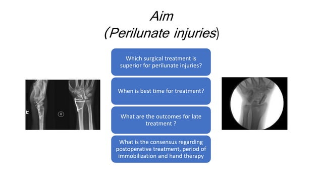 Perilunate Injury Timing and Treatment Options final.pptx