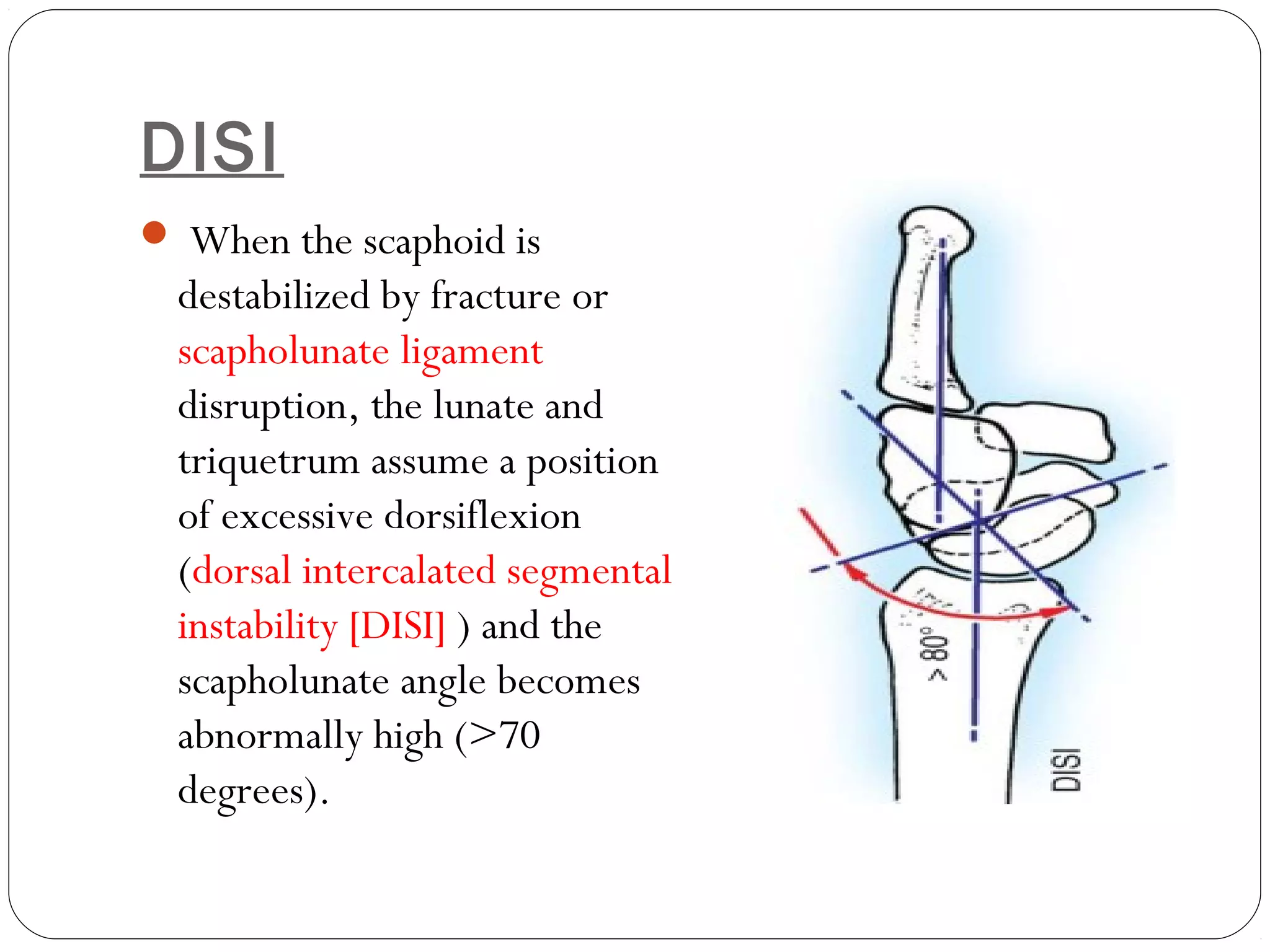 Perilunate dislocations | PPT