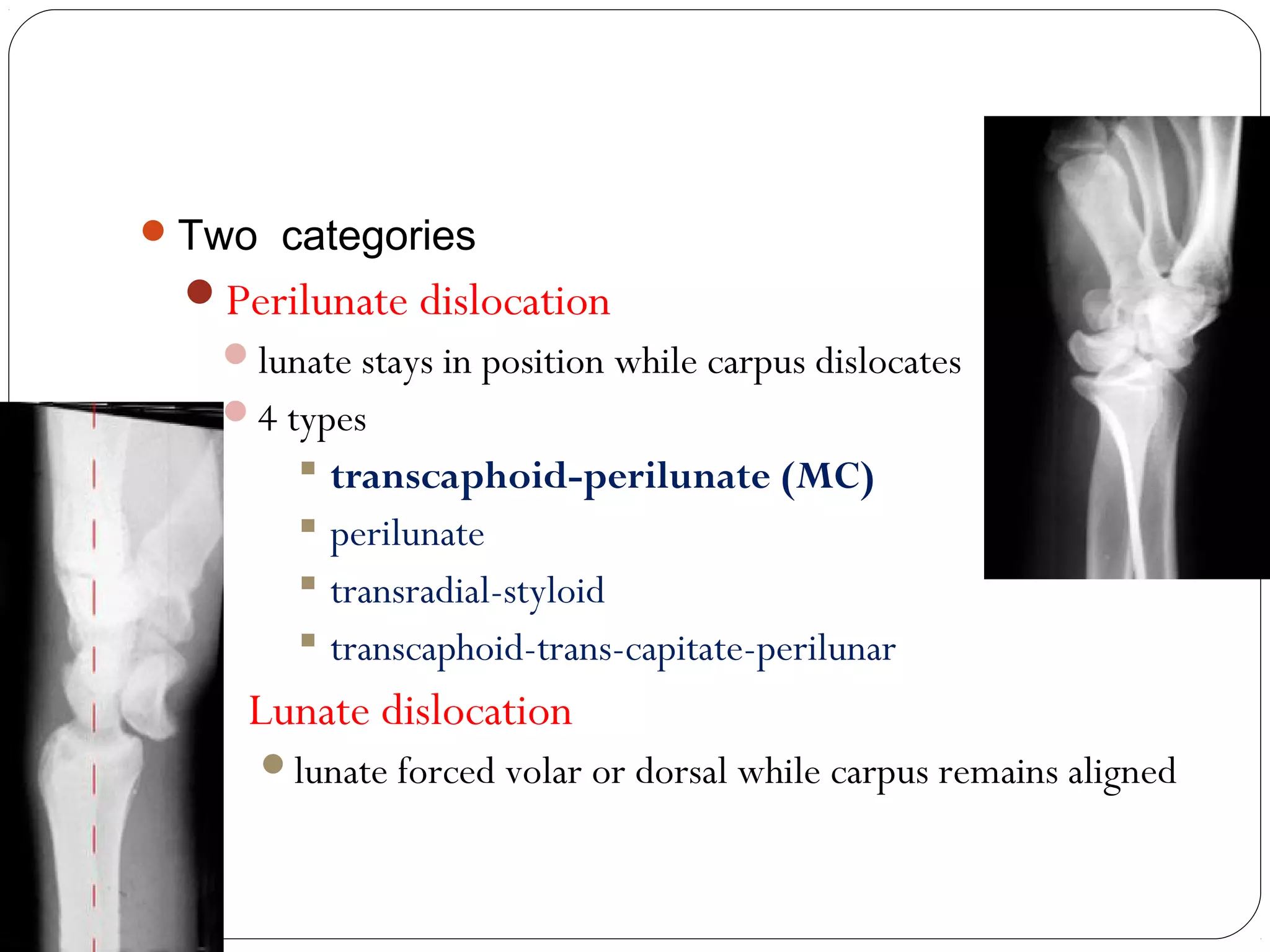 Perilunate dislocations | PPT