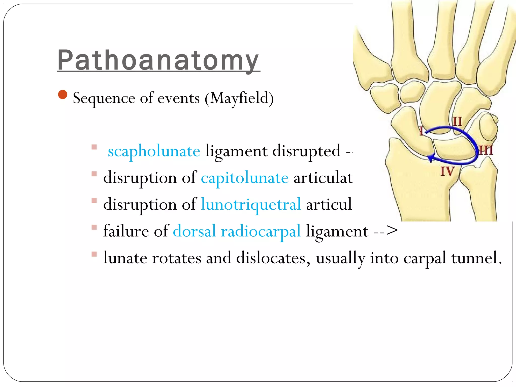 Perilunate dislocations | PPT