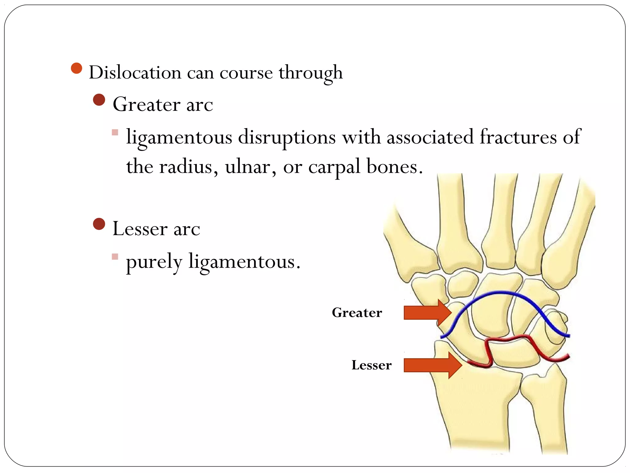 Perilunate dislocations | PPT