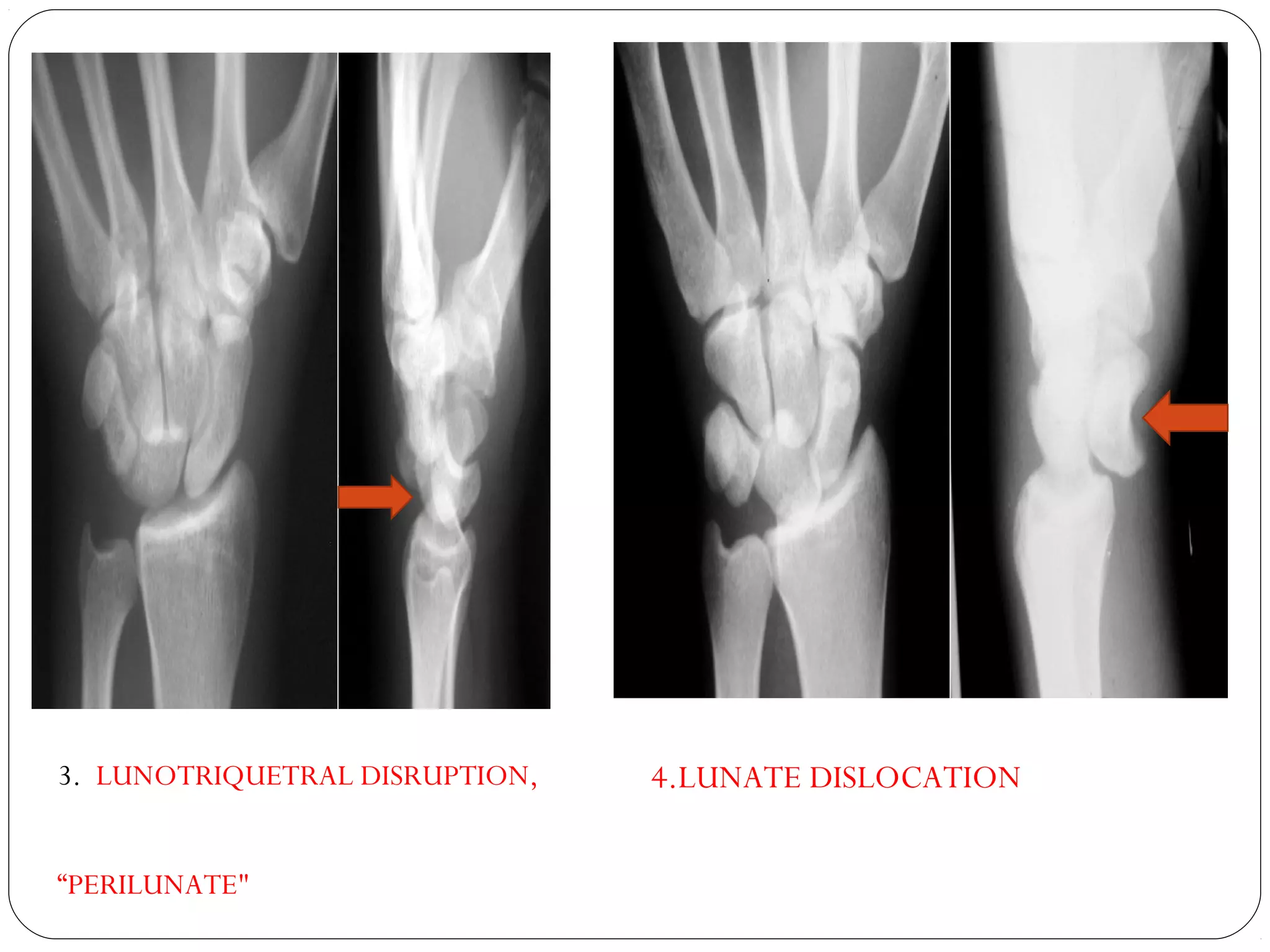 Perilunate dislocations | PPT