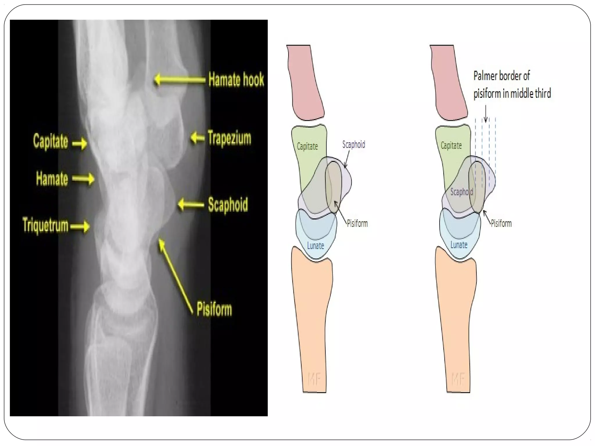 Perilunate dislocations | PPT