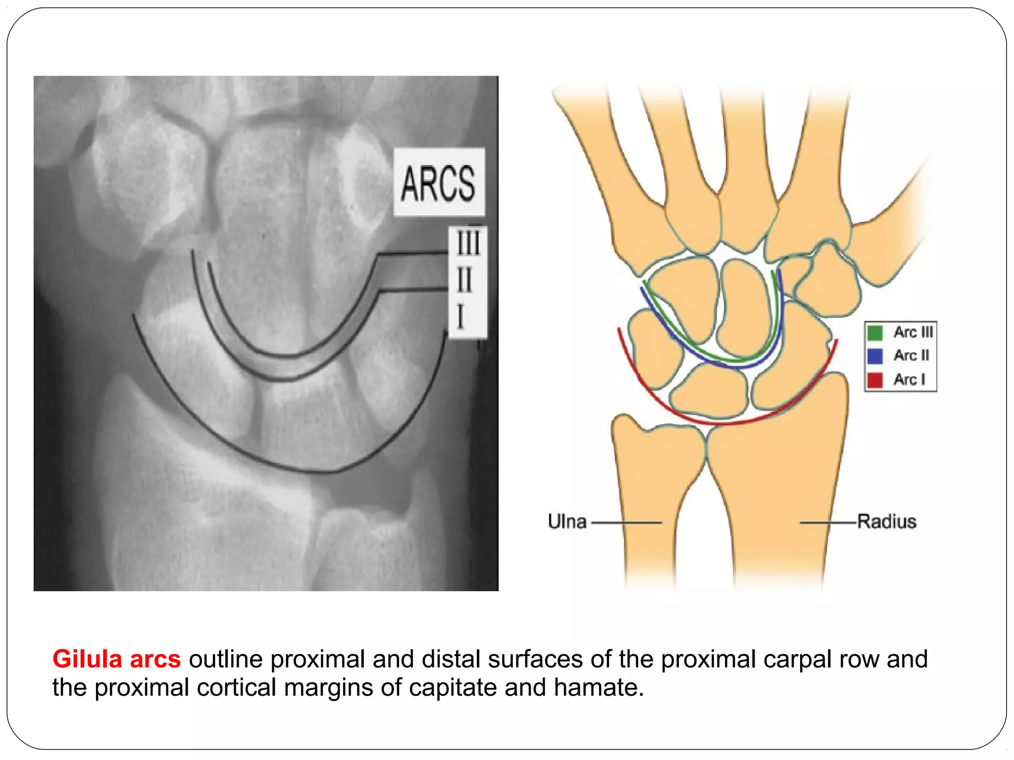 Perilunate dislocations | PPT