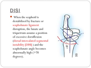 Perilunate dislocations | PPT | Death, Injury, or Military Conflict ...
