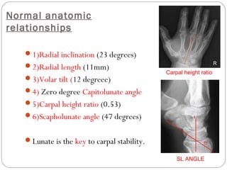 Perilunate dislocations | PPT