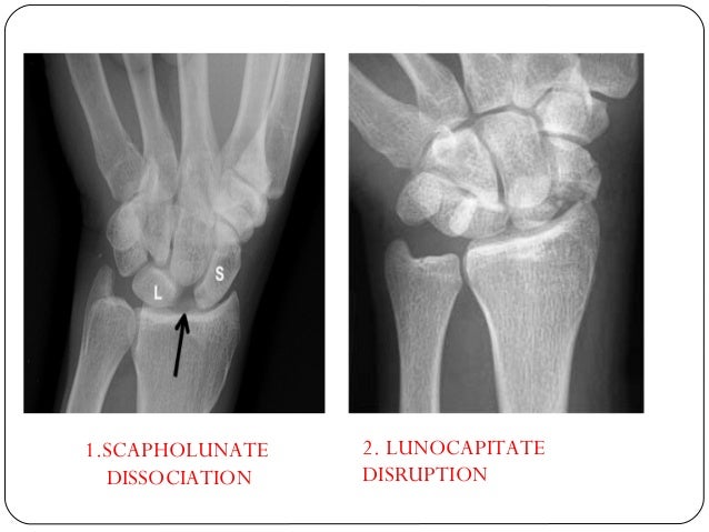 Lunate And Perilunate Dislocations Wikiradiography