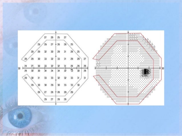 Visual Field Examination