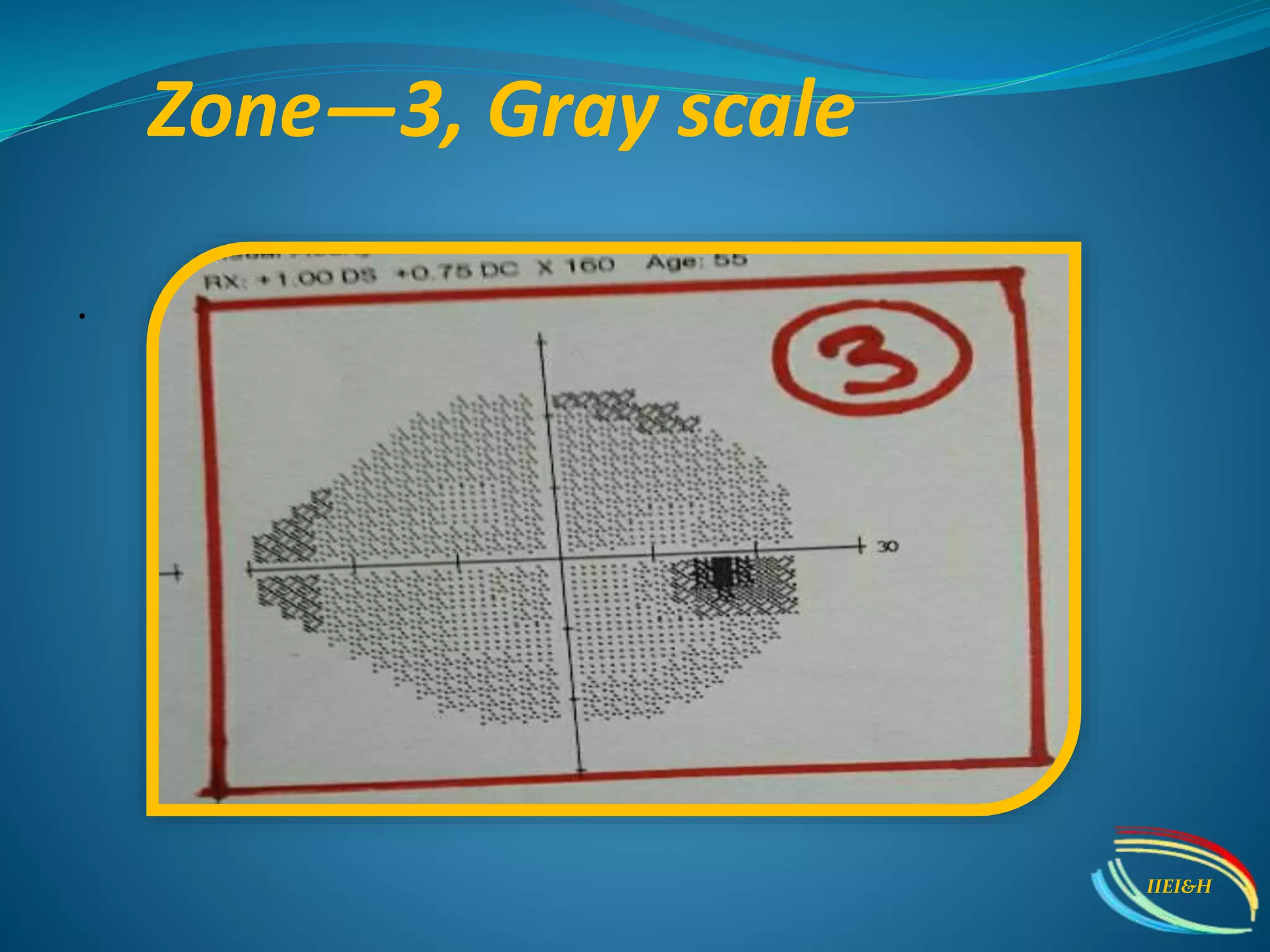 Humphrey visual field analyser (HVFA) | PPTX