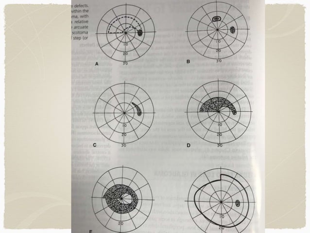Perimetry | PPTX | Eye and Vision Conditions | Diseases and Conditions