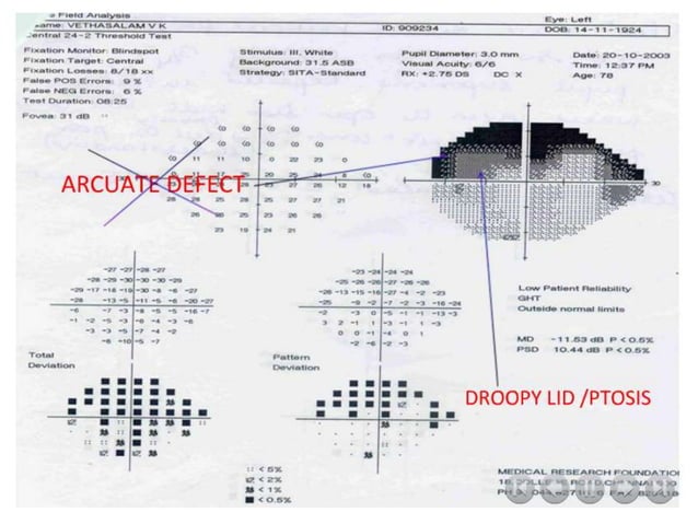 Perimetry | PPTX | Eye and Vision Conditions | Diseases and Conditions