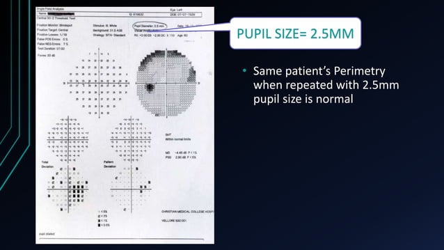 Perimetry | PPTX | Eye and Vision Conditions | Diseases and Conditions