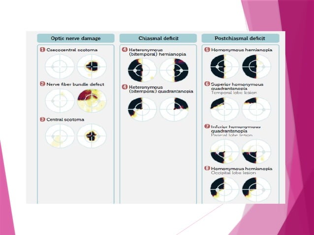 perimetry , it's types, clinical features, treatment.pptx