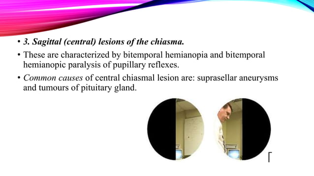 Perimetry & Effects of lesions at different levels of VISUAL PATHWAY ...