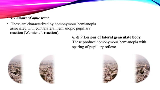 Perimetry & Effects of lesions at different levels of VISUAL PATHWAY ...