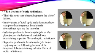 Perimetry & Effects of lesions at different levels of VISUAL PATHWAY ...