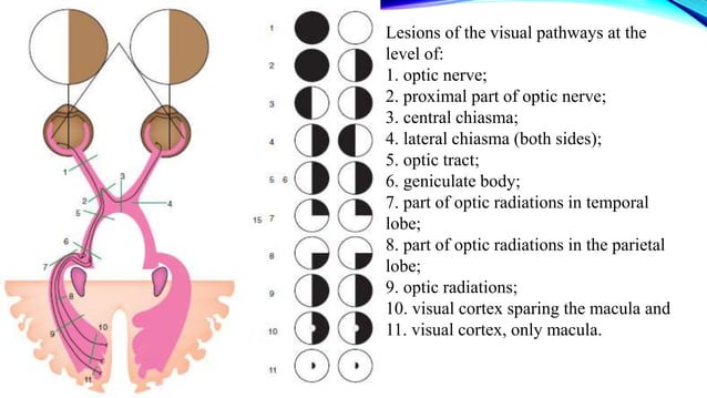 Perimetry & Effects of lesions at different levels of VISUAL PATHWAY ...