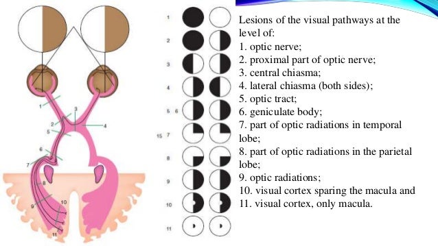 Pin Anatomy Of Visual Pathway Field Defects And Its L - vrogue.co