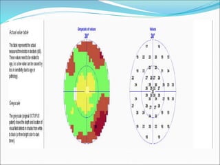 Perimetry is the technique of evaluating the Visual field . | PPT