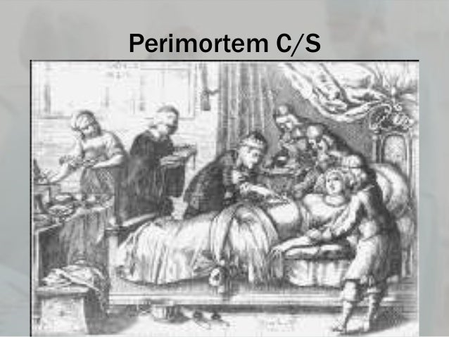 Peri-Mortem C-Section in the Emergency Department : Dr Peter Soltau e…